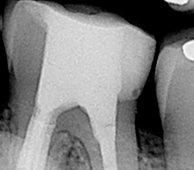 XP-3D Shaper - Next Generation Endodontic Instrumentation