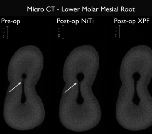 XP-3D Finisher - The Next Generation of Endodontic Instrumentation